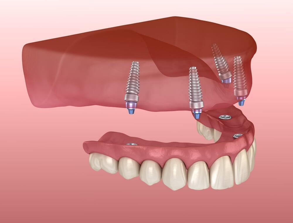 Dentures